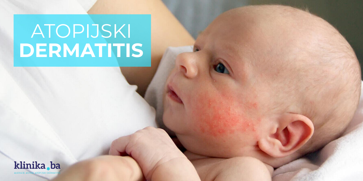 Dermatitis Atopica - Klinika.ba
